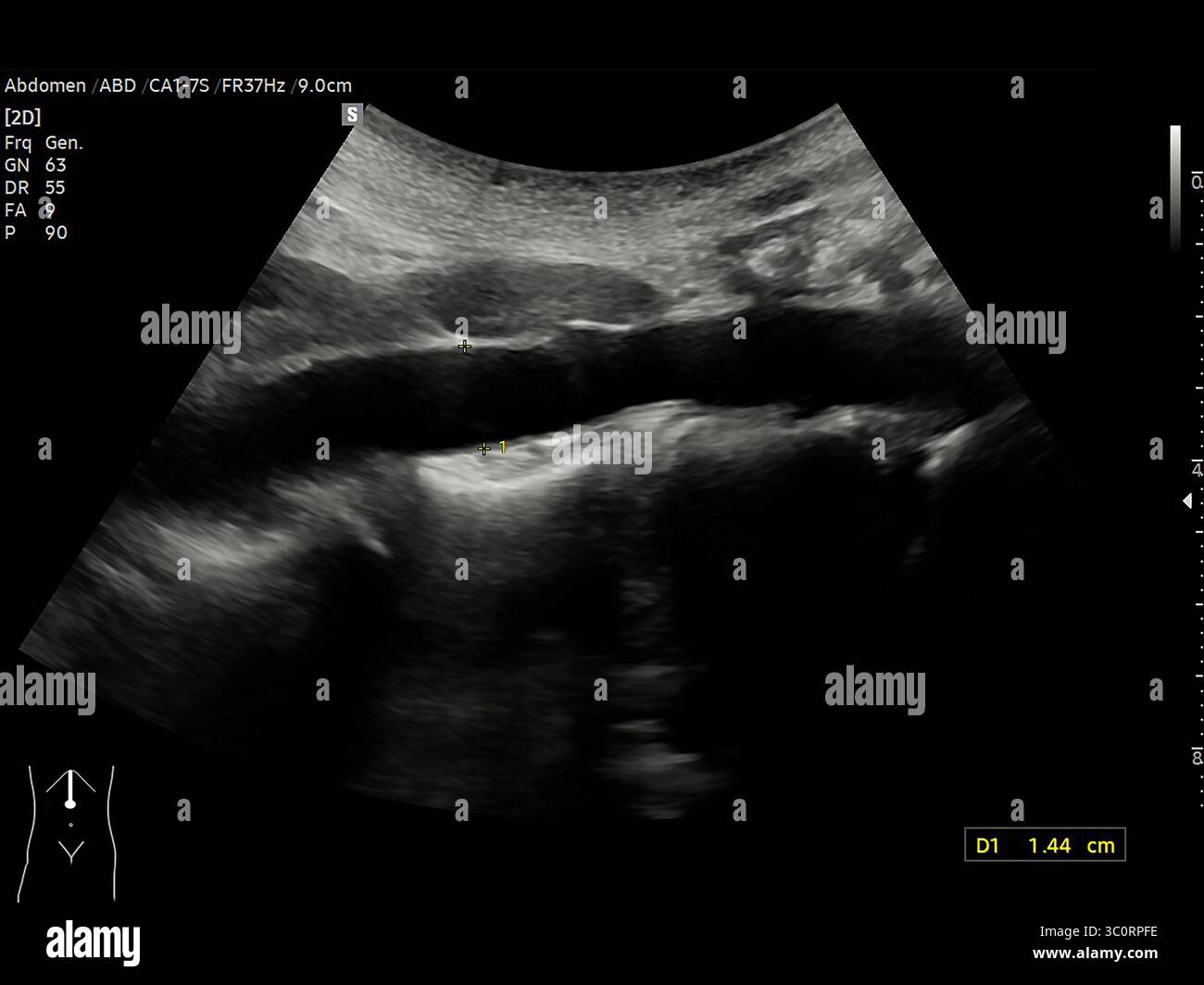 A normal ultrasound of the upper abdomen, showing healthy organs with ...