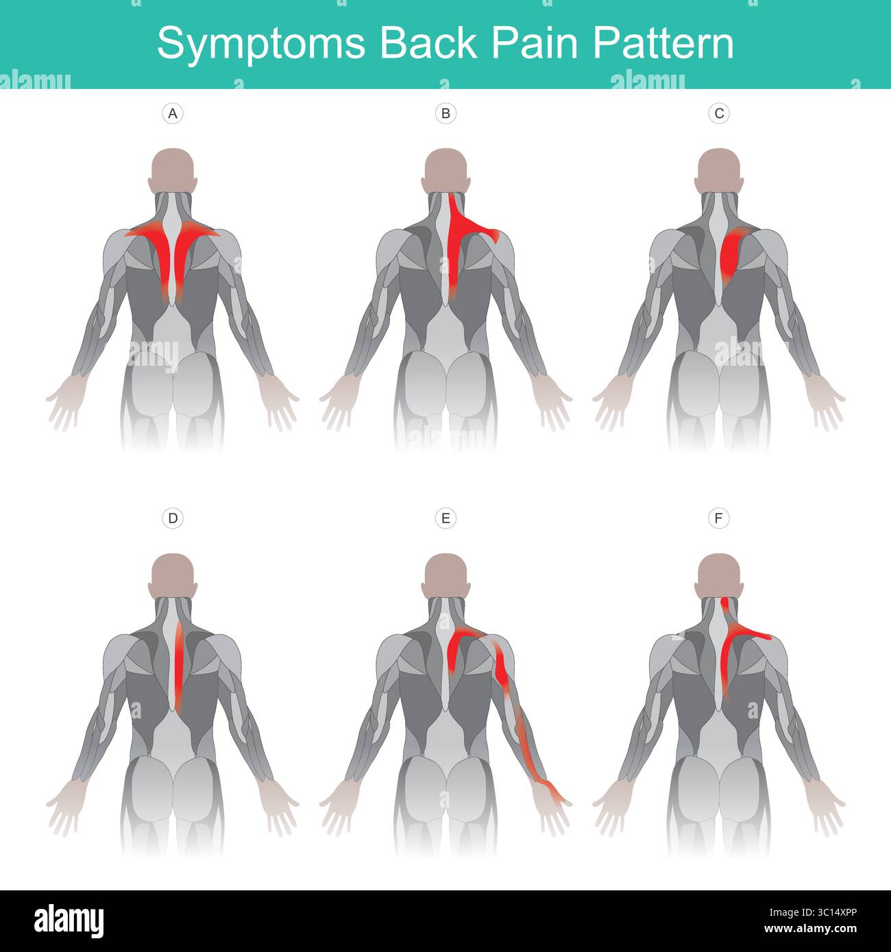 Neck muscle therapy Stock Vector Images - Alamy