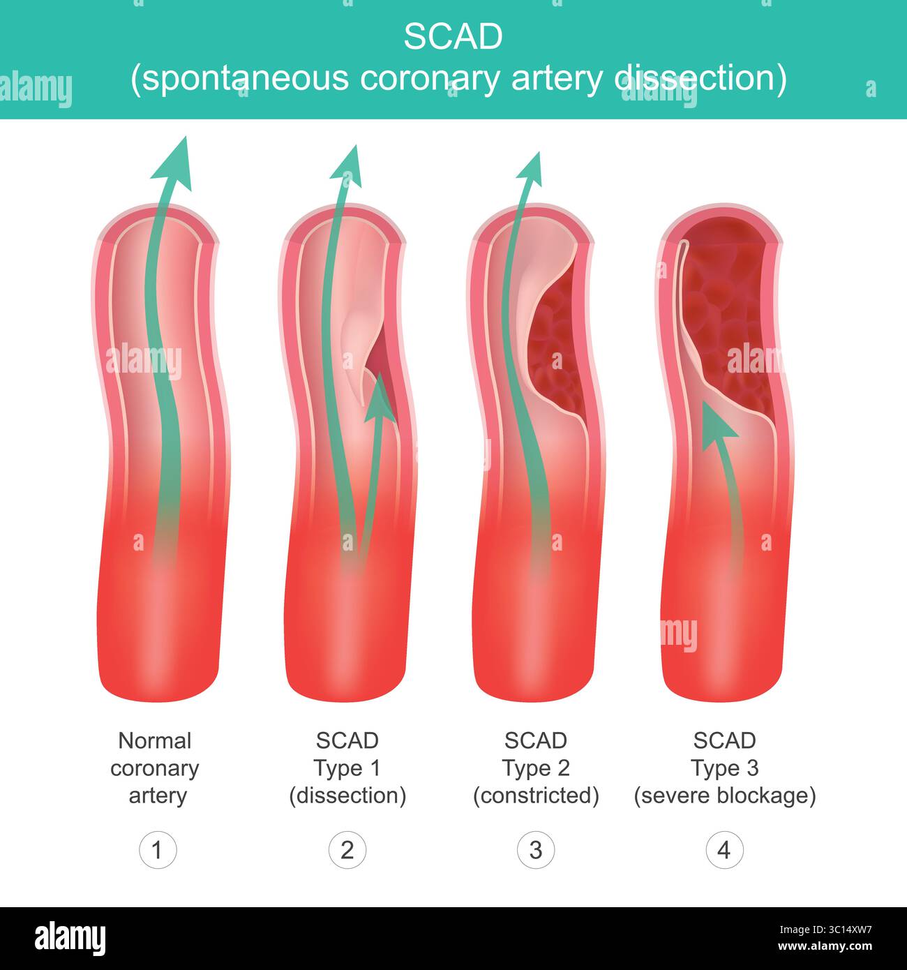 Types of Spontaneous Coronary Artery Dissection (SCAD Stock Vector ...