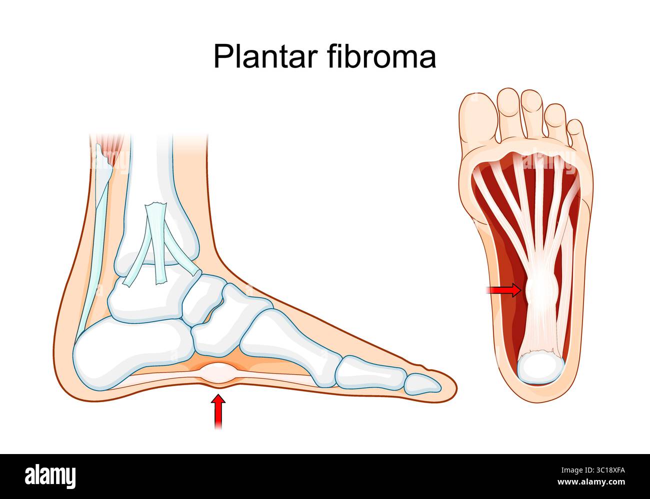 Plantar fibroma. Plantar fascial fibromatosis. Ledderhoses disease ...
