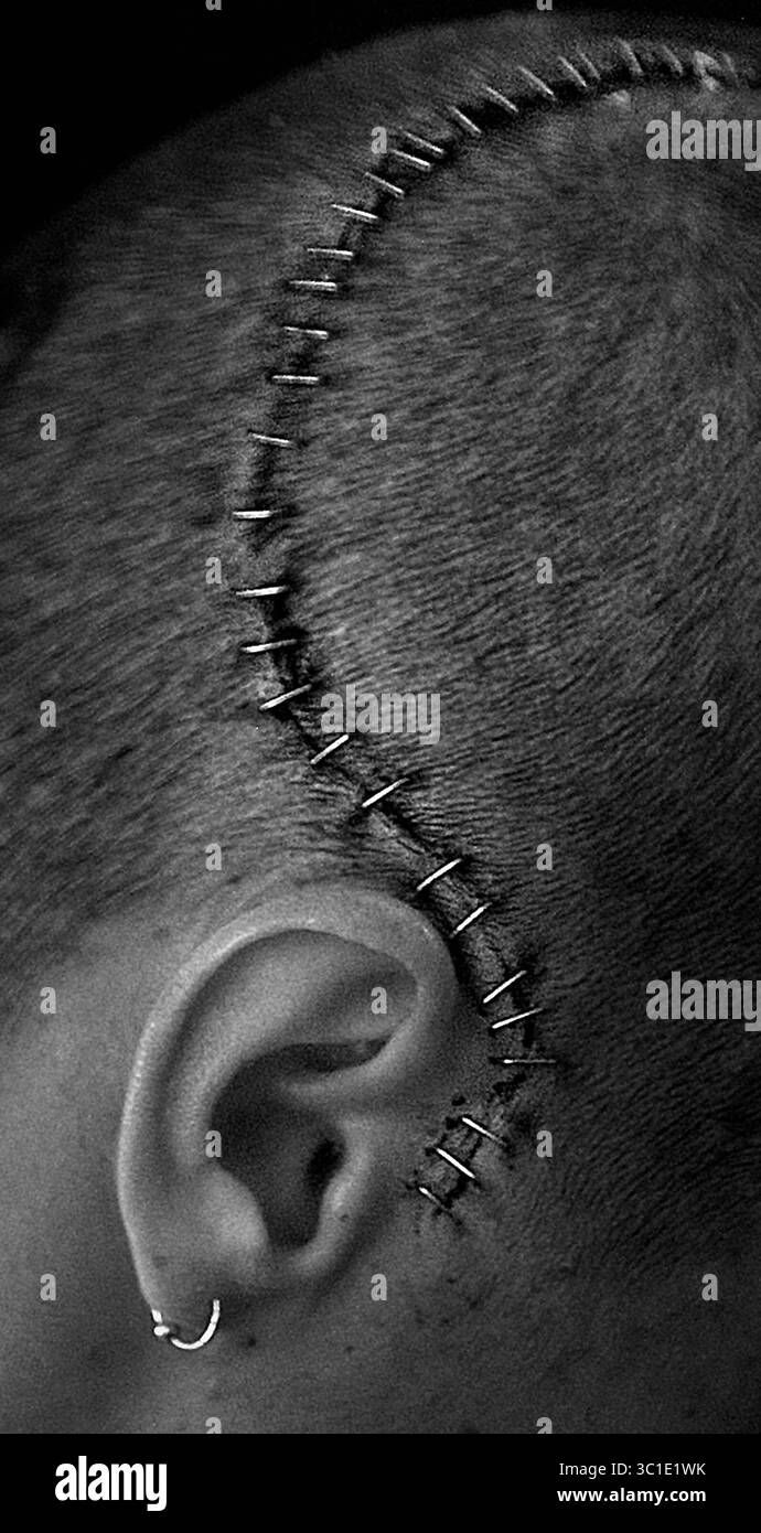 Aug. 27, 2004 - Bethesda, Maryland, U.S. - It took 66 staples to ...