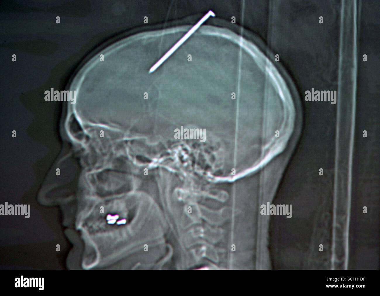 Arteries of the brain hi-res stock photography and images - Alamy