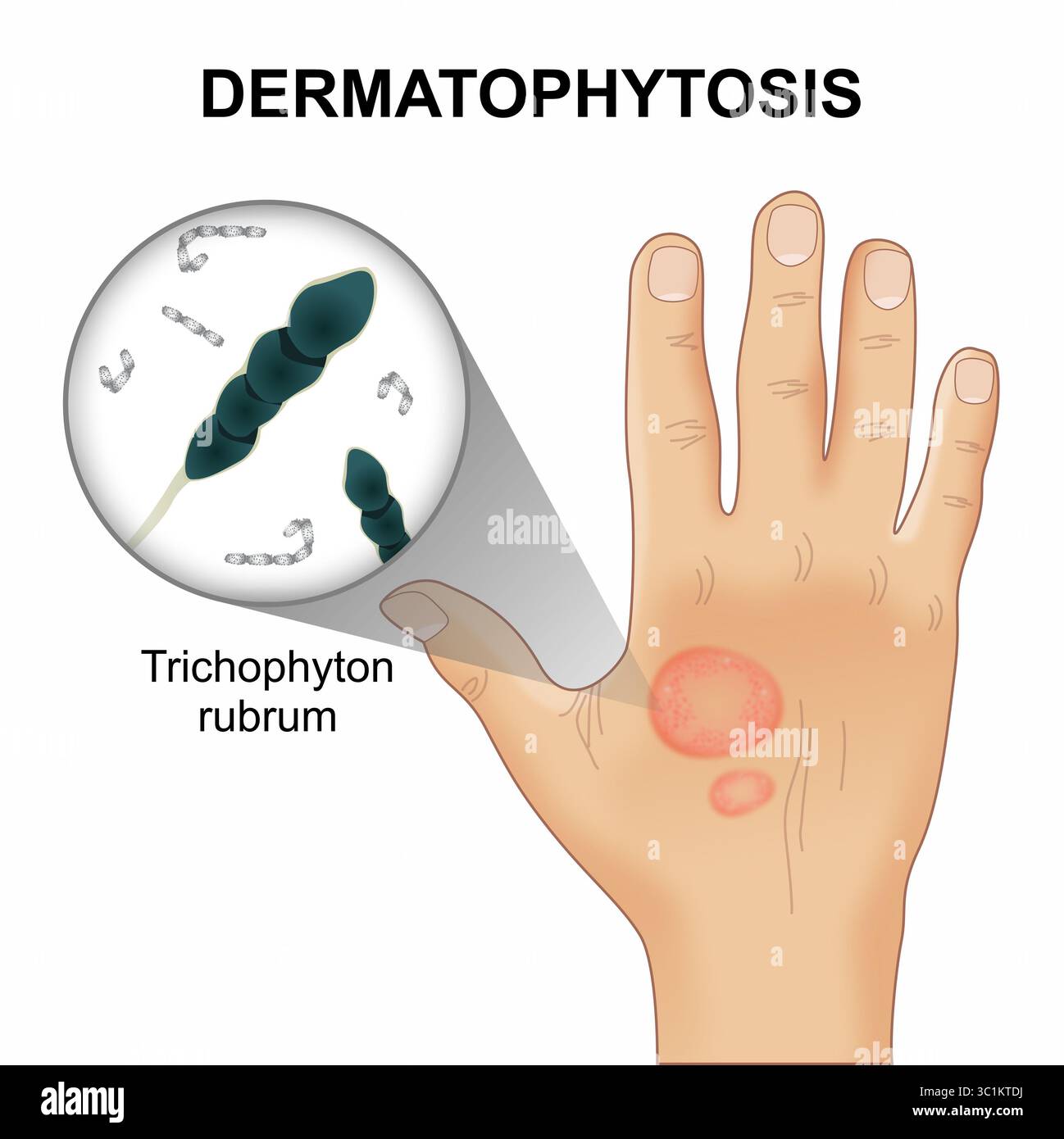 Dermatophytosis trichophyton rubrum skin infection Stock Photo - Alamy