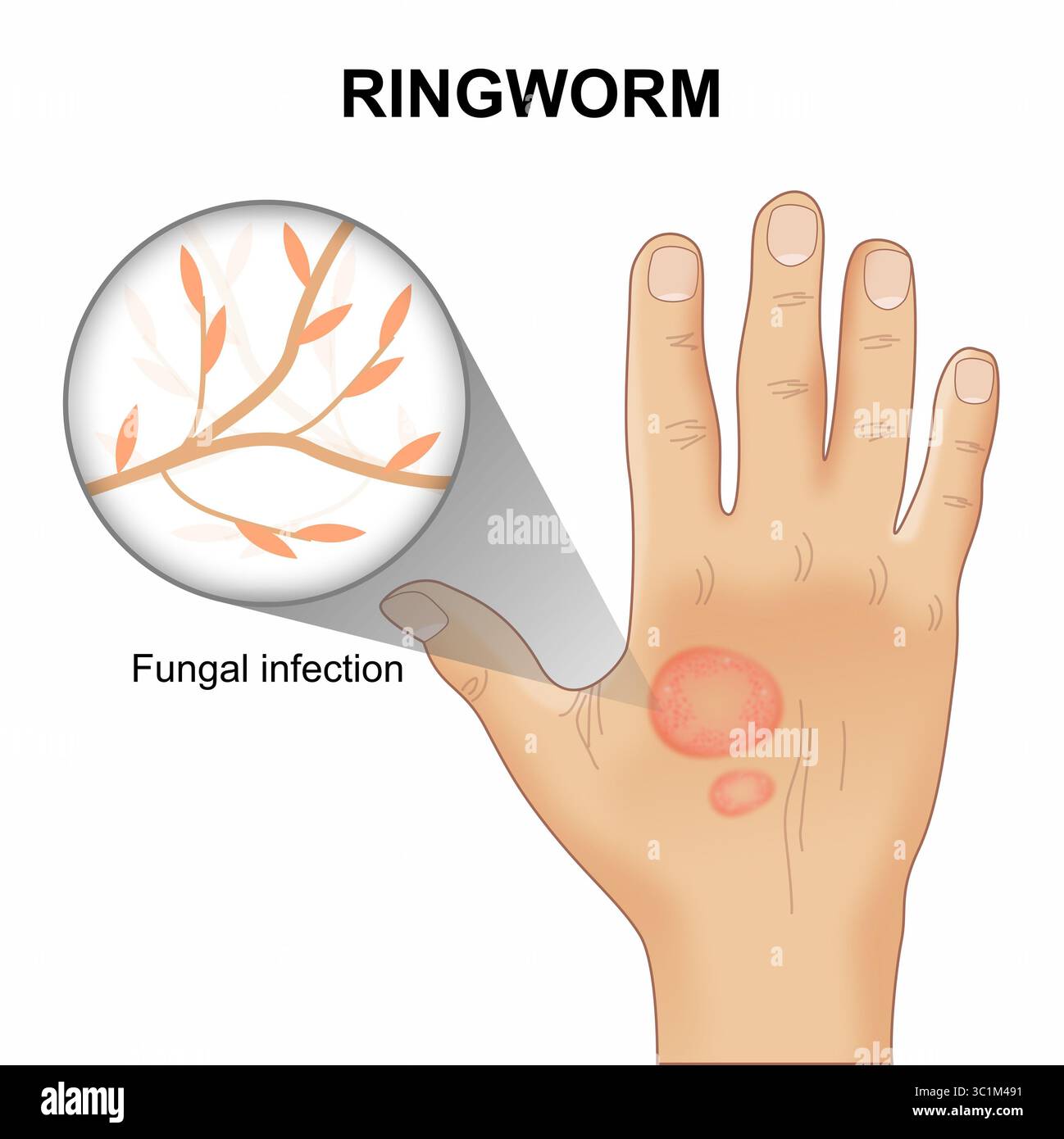 Fungal condition Cut Out Stock Images & Pictures - Alamy