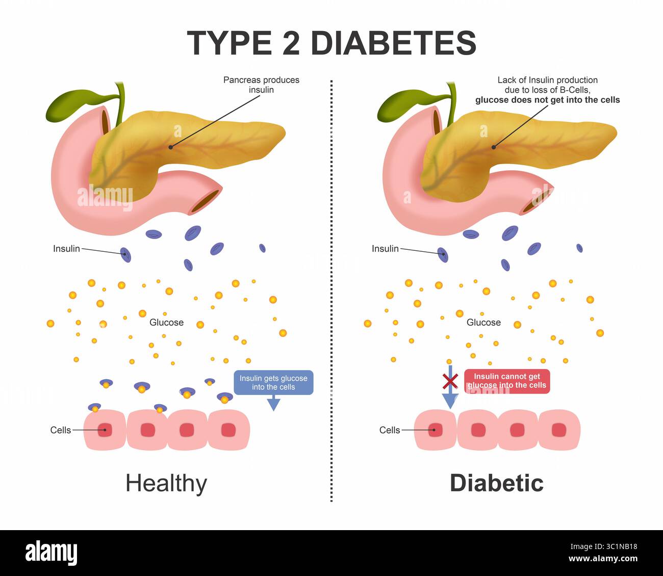 Diabetes infographic diabetic hi-res stock photography and images - Alamy