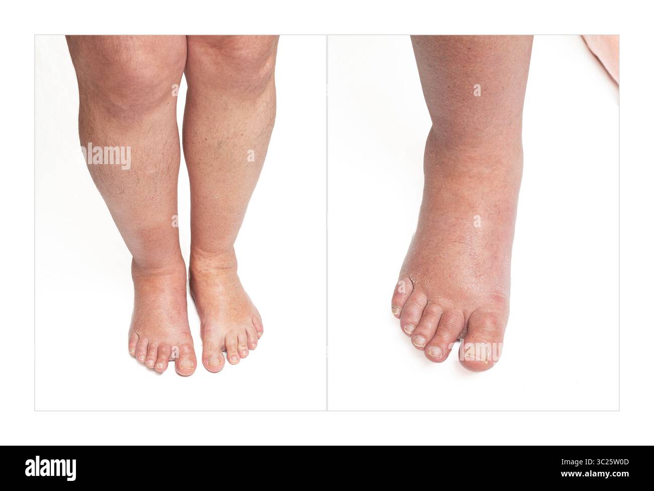 Collage of swollen legs caused by a broken toe. Unrecognizable man with ...