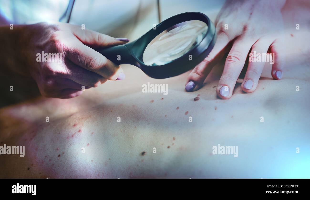 Dermatologist examining the skin on the back of a patient; light effect ...