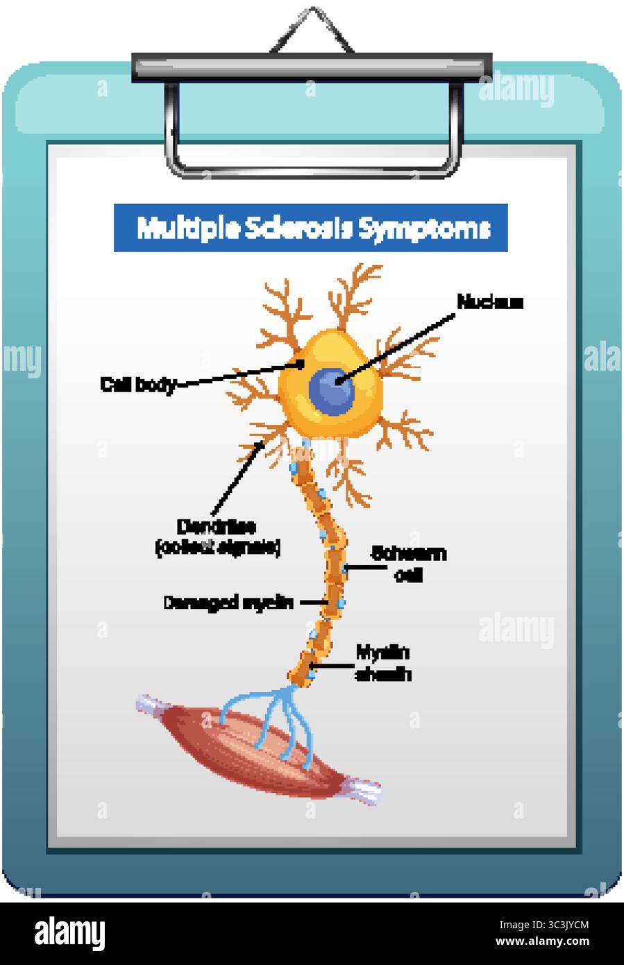 Vector illustration of a neuron showing damaged myelin, labeled parts, and multiple sclerosis ...
