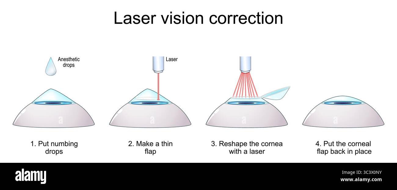 Ophthalmic procedure Stock Vector Images - Alamy