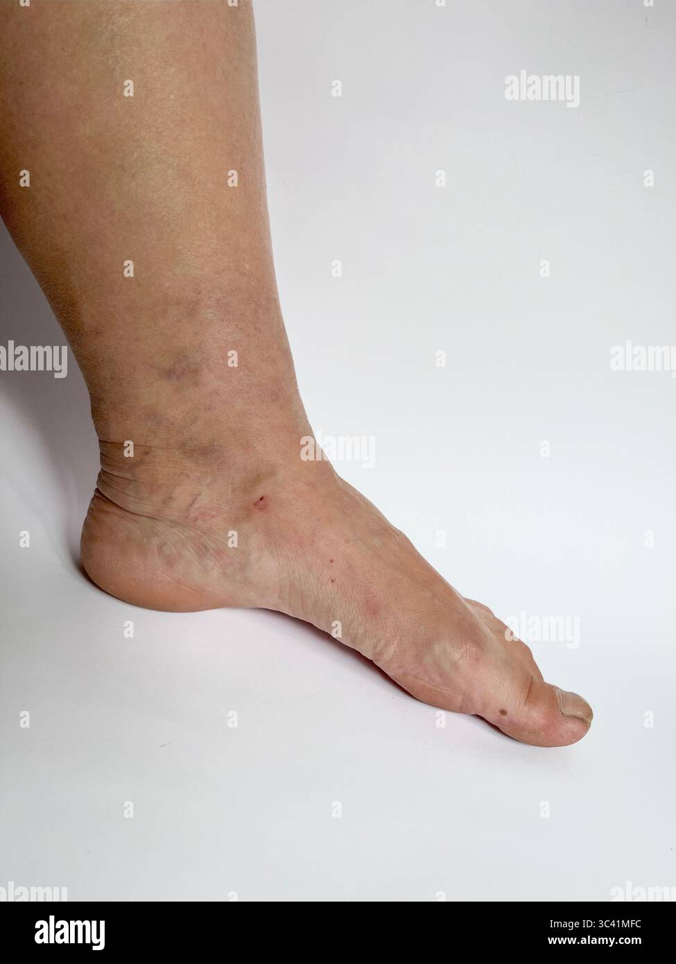 Advanced varicose condition-persistent pain,limited mobility and severe ...