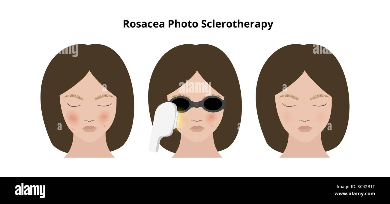Rosacea photosclerotherapy treatment showing before, during, and after ...