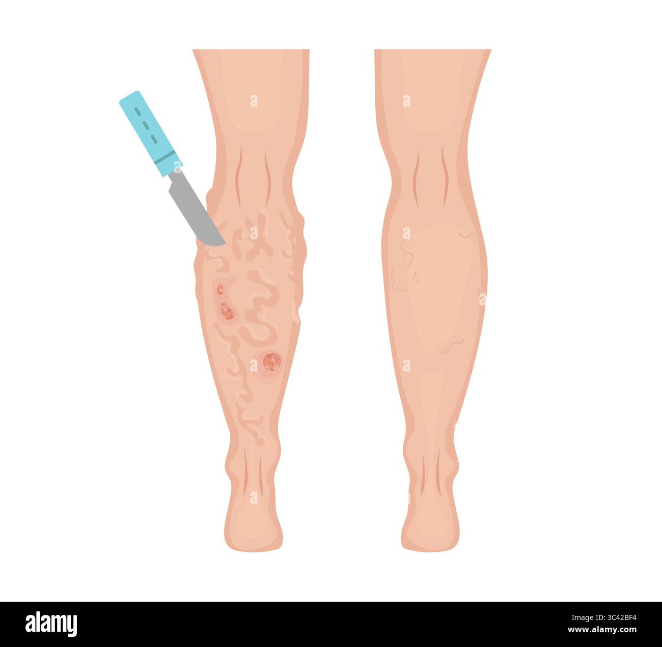 Operation varicose veins leg hi-res stock photography and images - Alamy