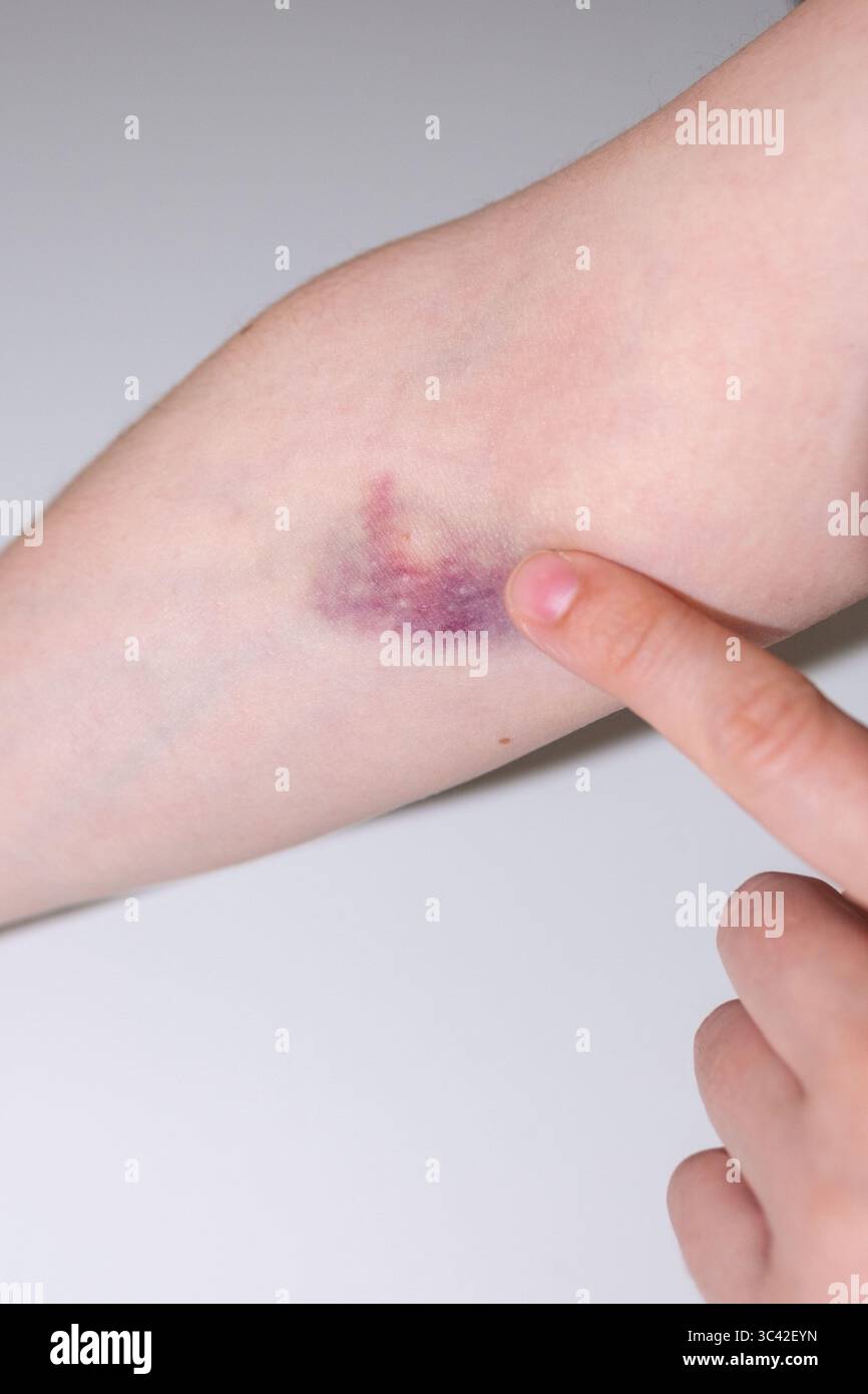 Close-up bruise on female hand donor skin after medical procedure ...