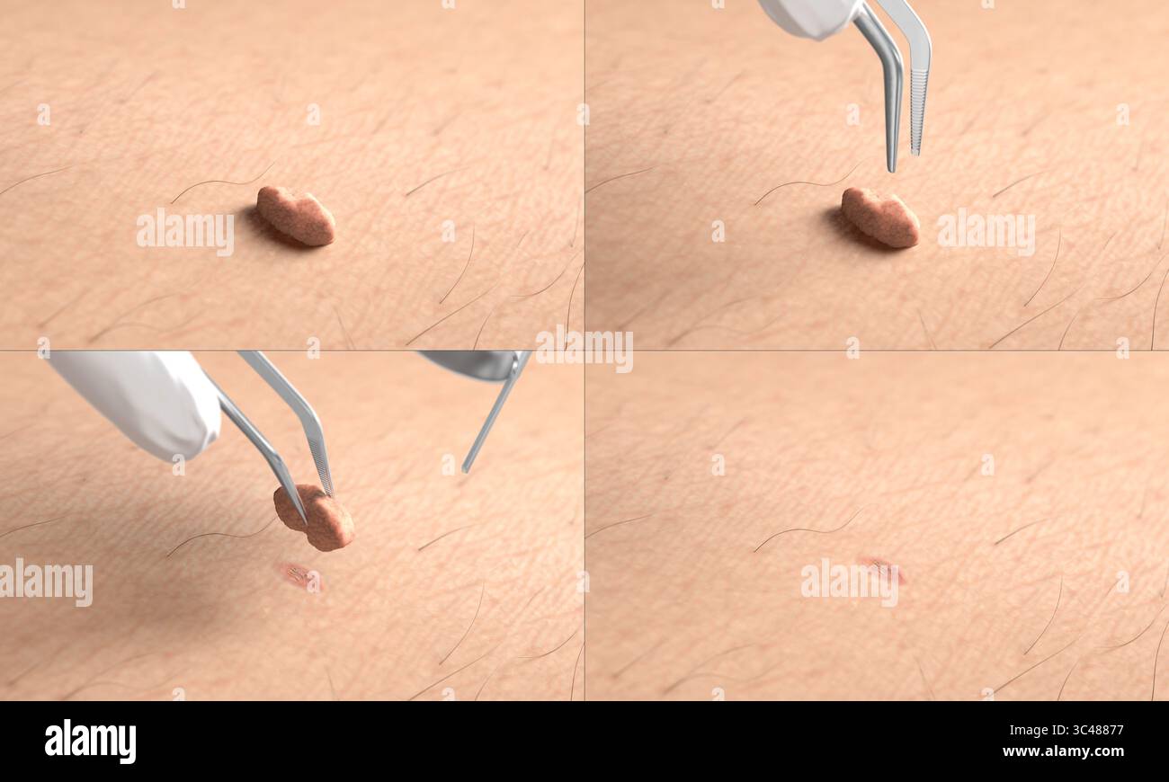Skin surface with papilloma laser removal treatment process macro Stock ...