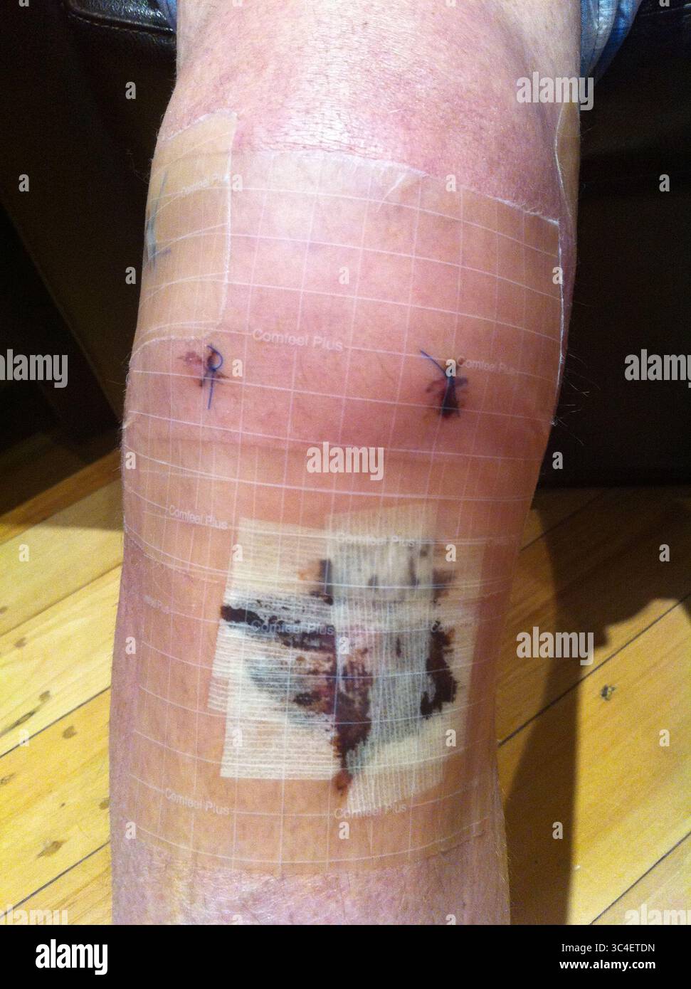 knee post acl reconstruction surgery using a hamstring graft Stock ...
