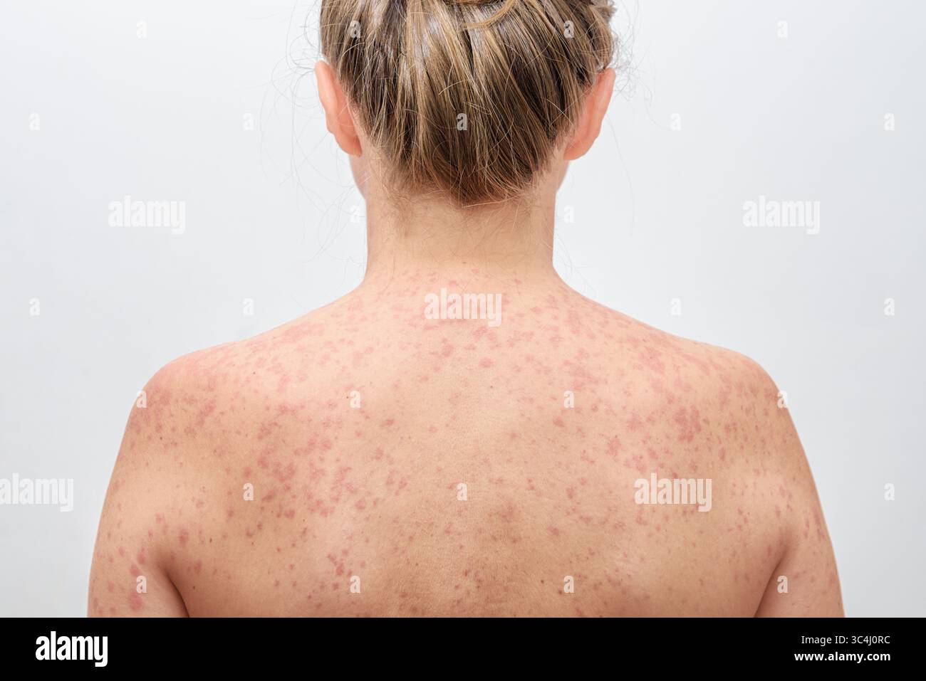 Measles rash back hi-res stock photography and images - Alamy