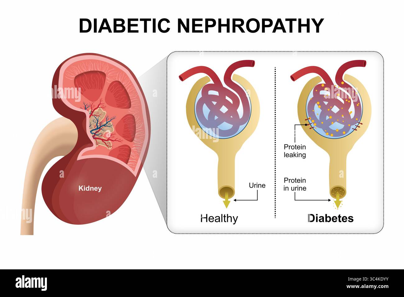 Diagram concept kidney failure hi-res stock photography and images - Alamy