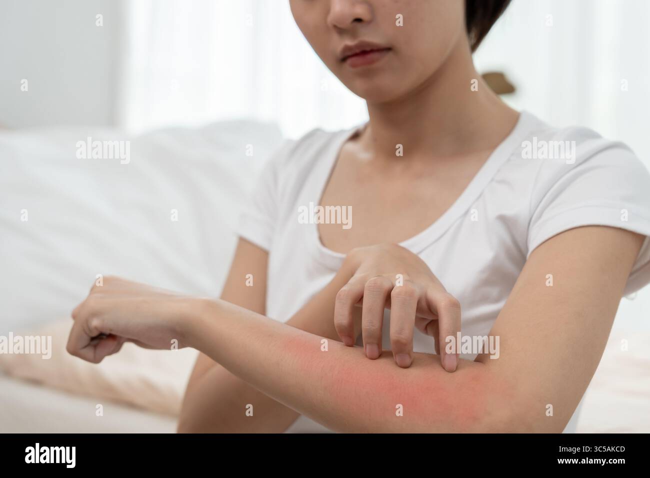 skin problem and beauty. Young woman scratch body has itchy skin from ...