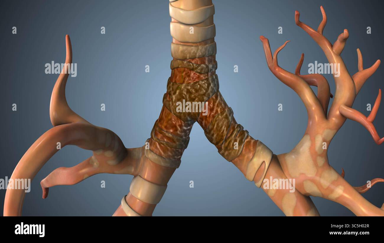 Tracheal damage hi-res stock photography and images - Alamy
