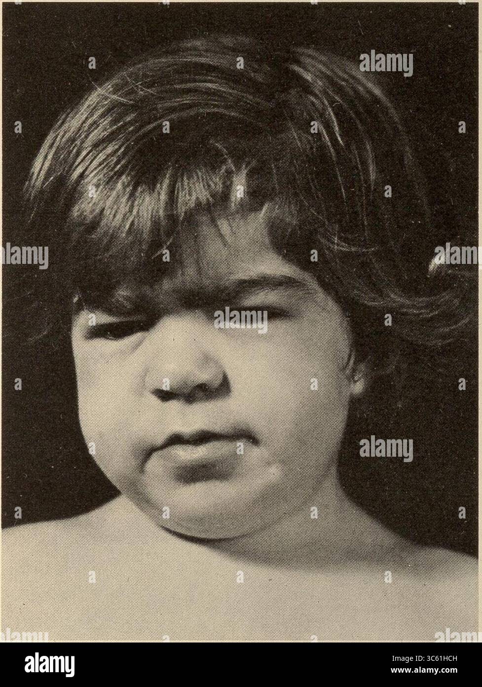 Mucopolysaccharidosis (Sanfilippo Syndrome) 1 Stock Photo - Alamy