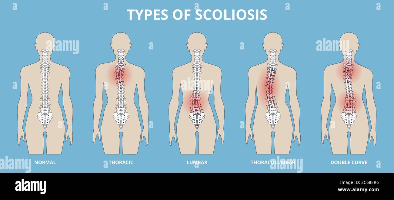 Scoliosis type. Spine curvature, different divisions, medical anatomy scheme, body distortion ...