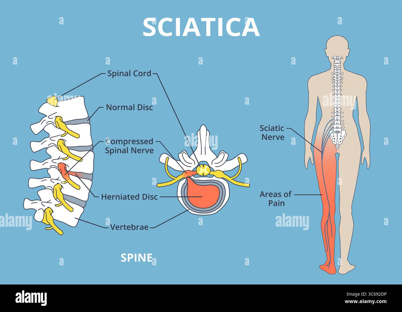 Sciatica pain scheme health hi-res stock photography and images - Alamy