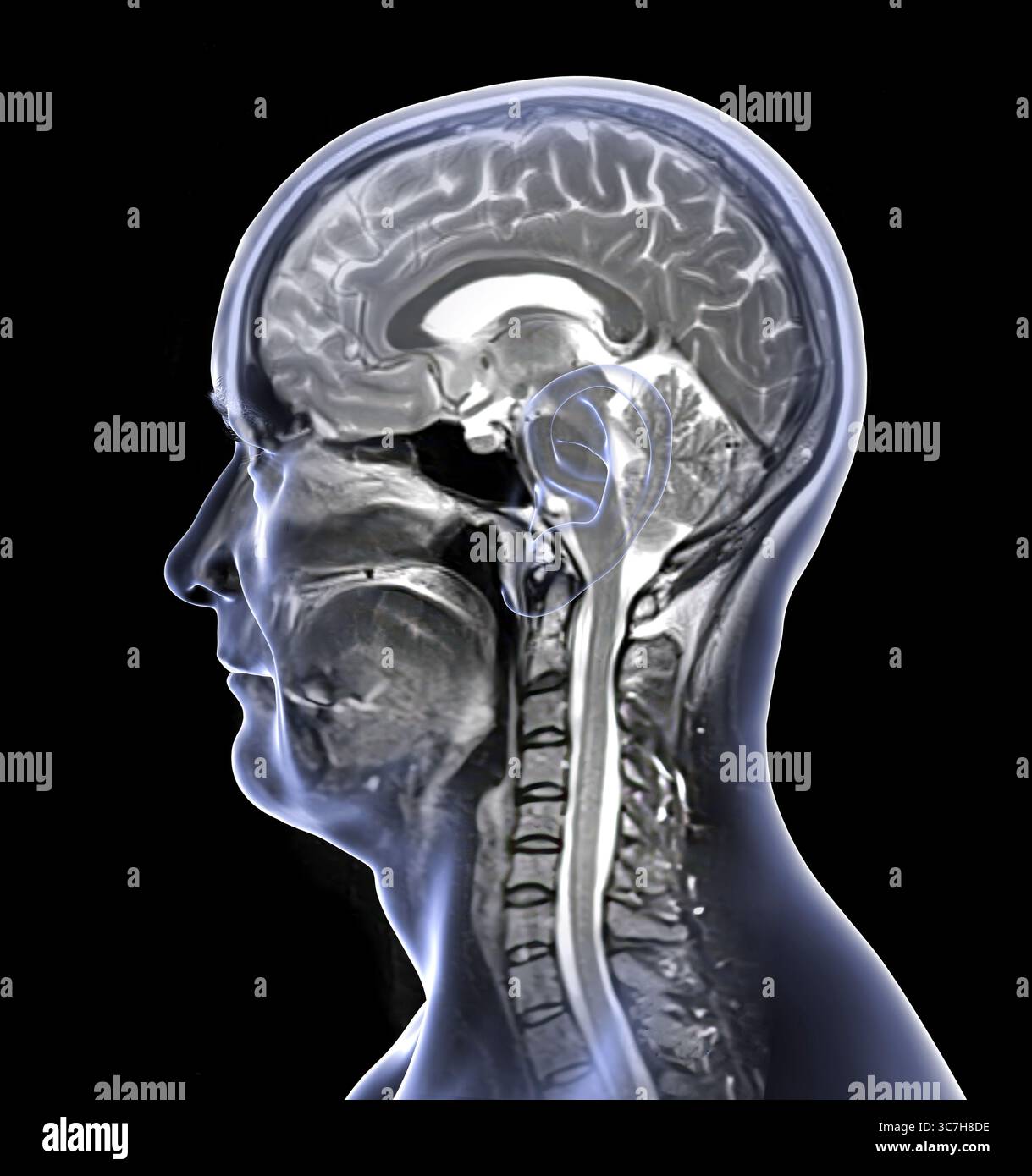 Mri Back Of Head And Neck