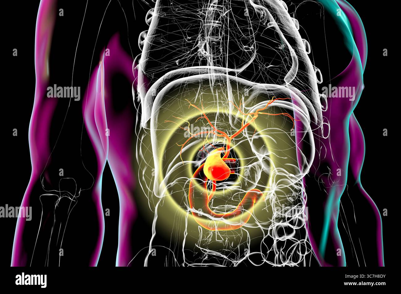 Conceptual illustration of gallbladder diseases, showing human body ...