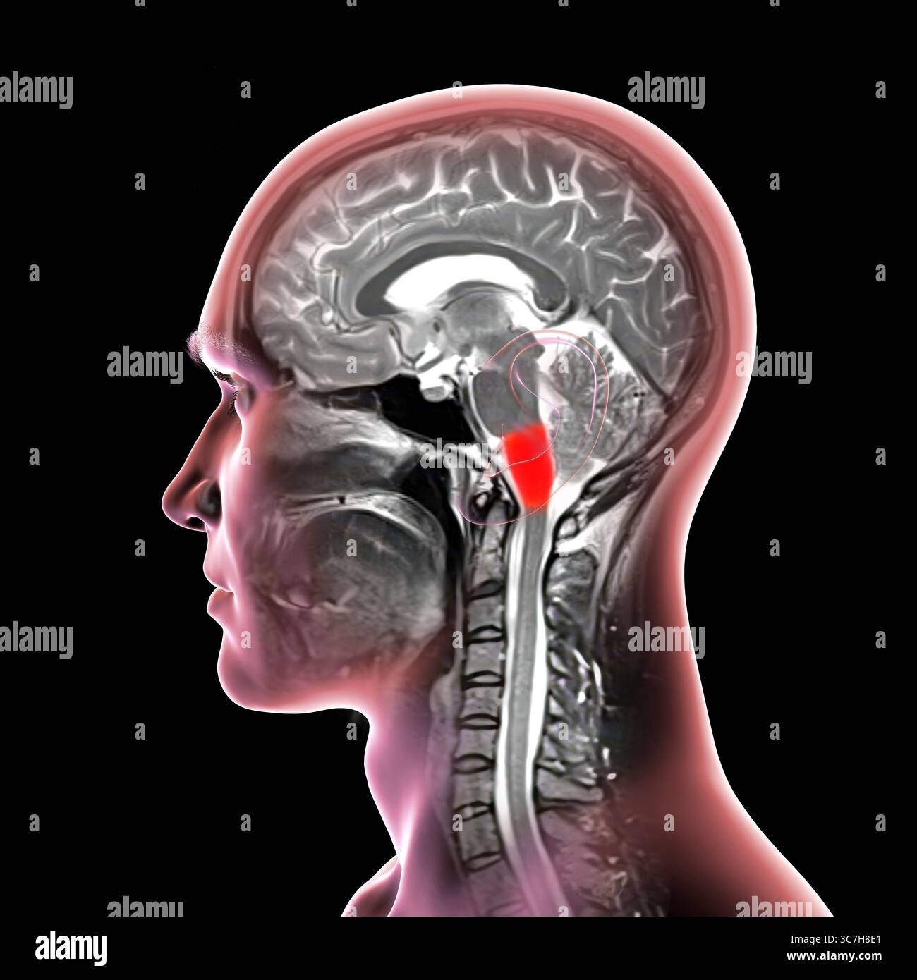 Illustration of a coloured magnetic resonance imaging (MRI) scan of the ...
