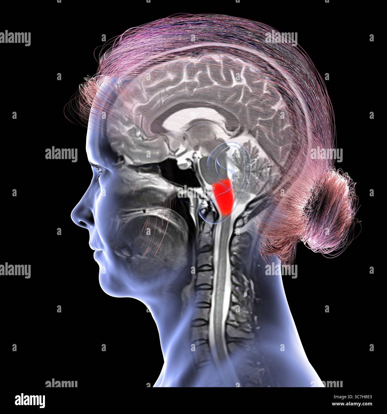 Illustration of a coloured magnetic resonance imaging (MRI) scan of the ...
