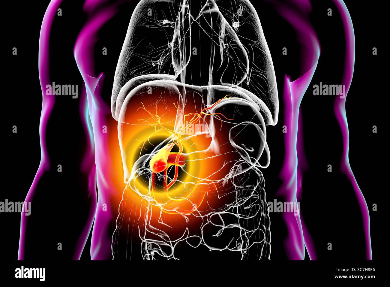 Acute cholecystitis biliary colic hi-res stock photography and images ...