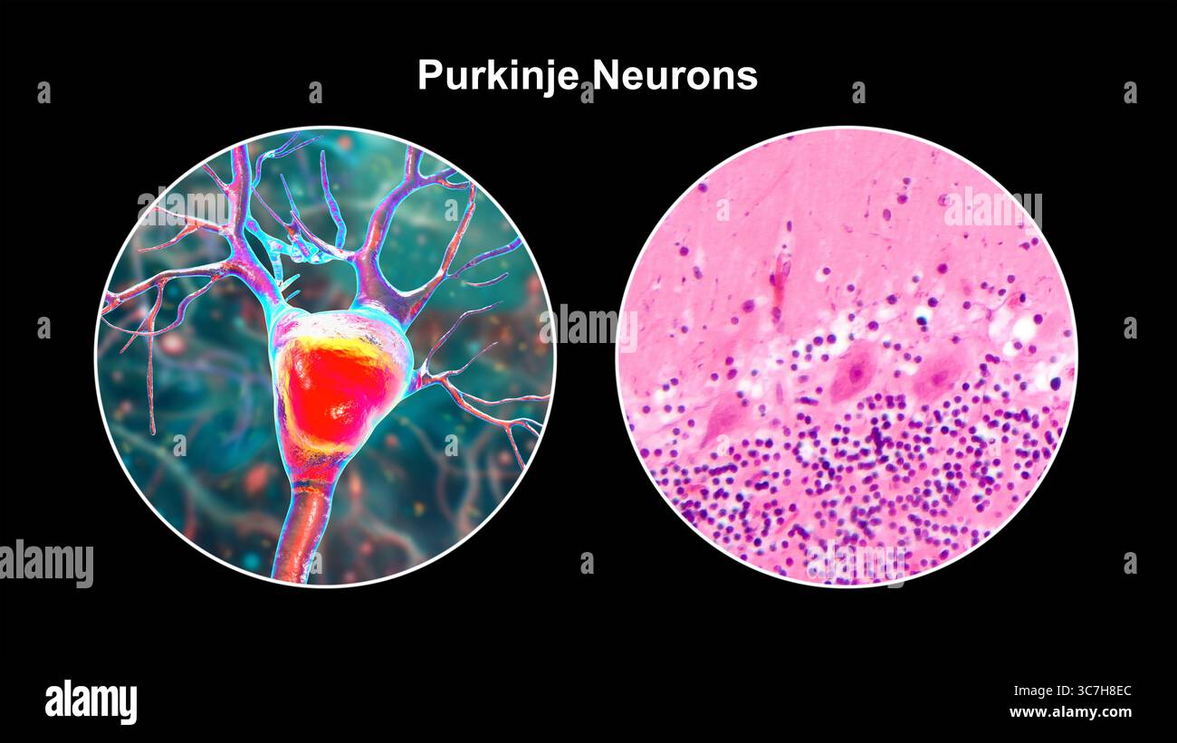 Illustration of Purkinje neurons and a light micrograph, showing large ...