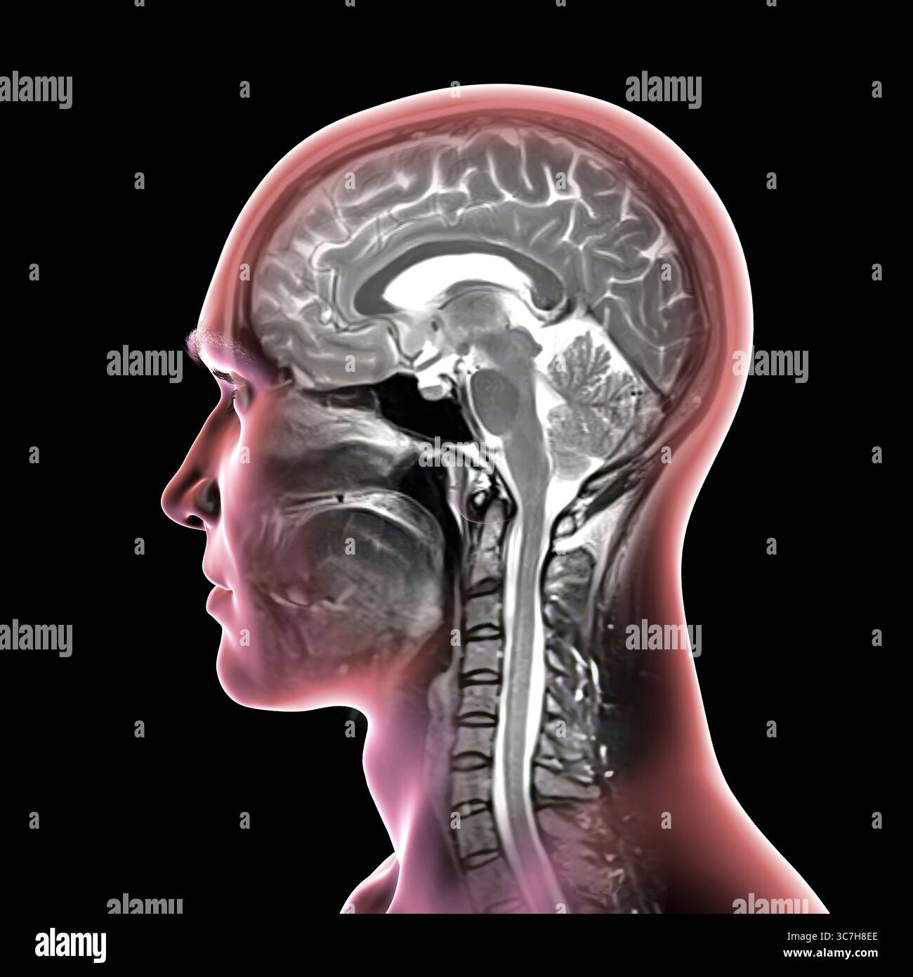 Illustration of a coloured magnetic resonance imaging (MRI) scan of the ...
