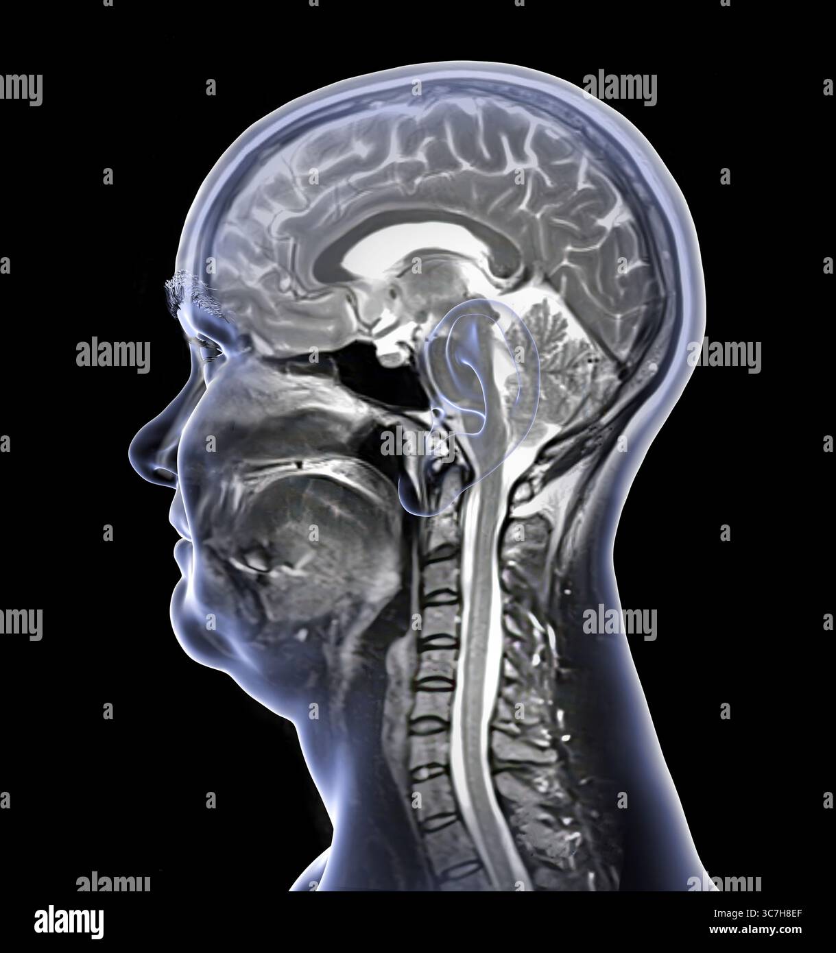 Illustration of a coloured magnetic resonance imaging (MRI) scan of the ...