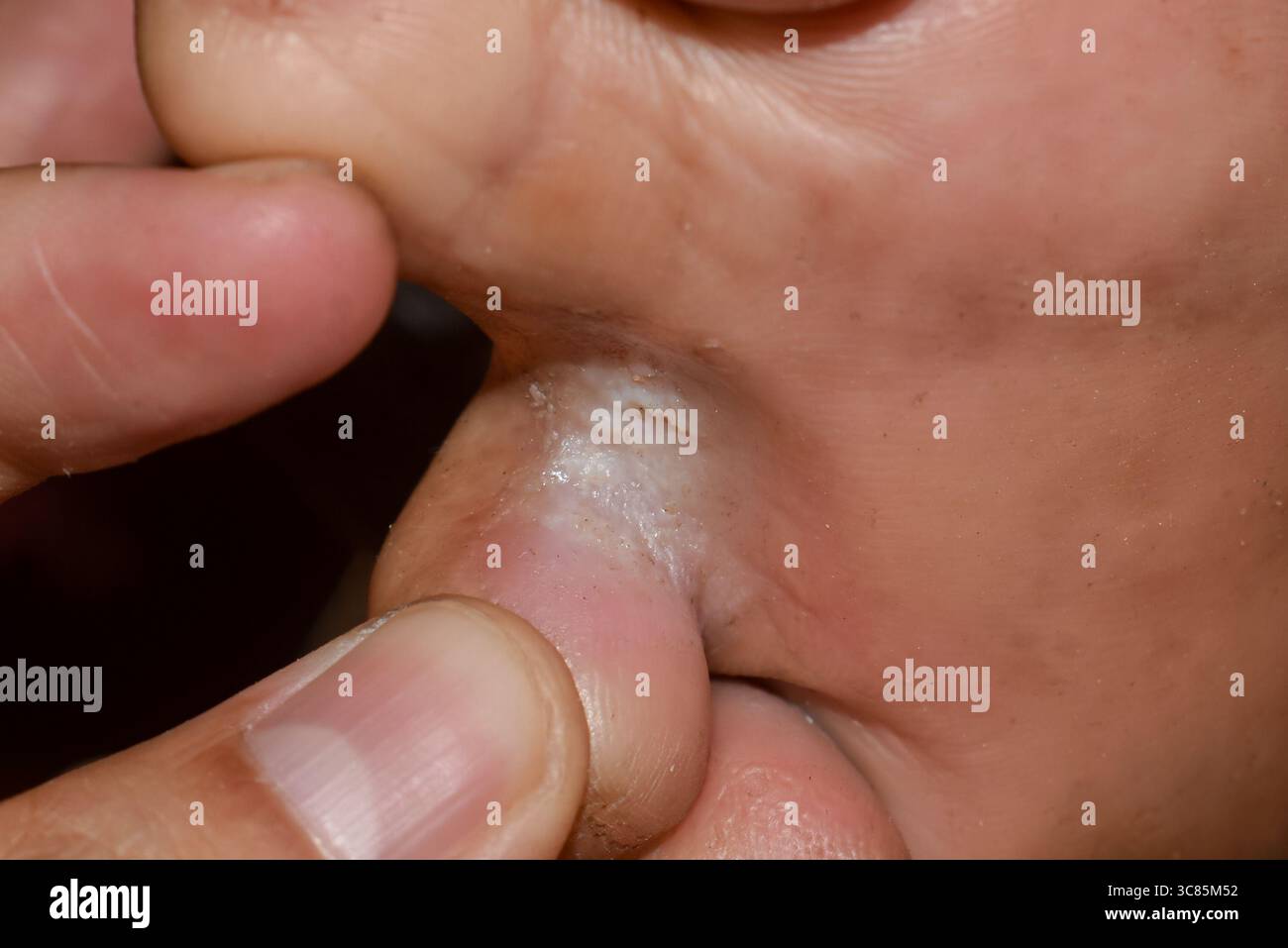 Closeup view of tinea pedis affecting the toe web space, characterized by white scaling ...