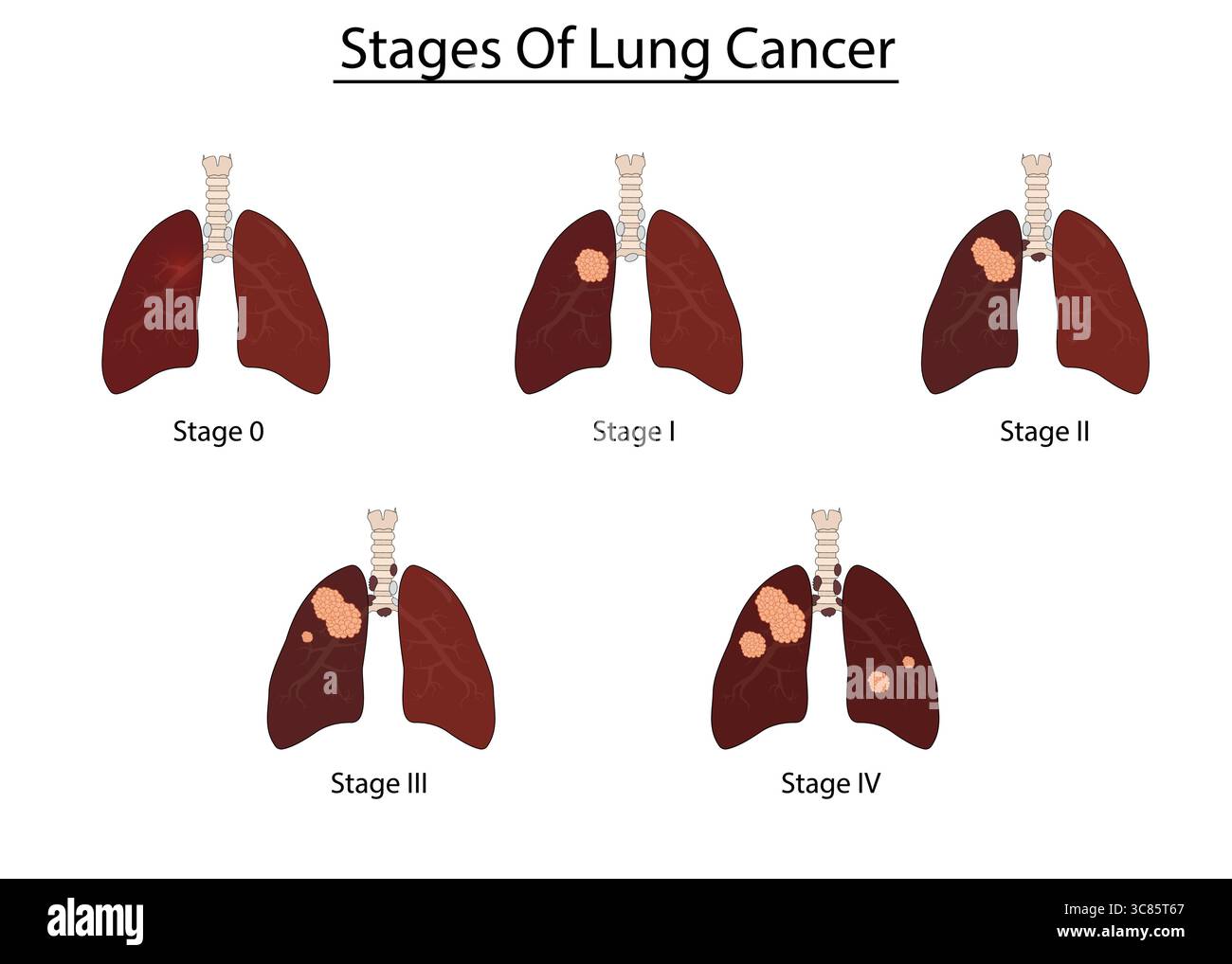 Cancer treatment radiology Stock Vector Images - Alamy