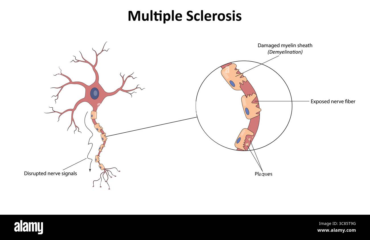 Multiple sclerosis vector illustration Stock Vector Image & Art - Alamy