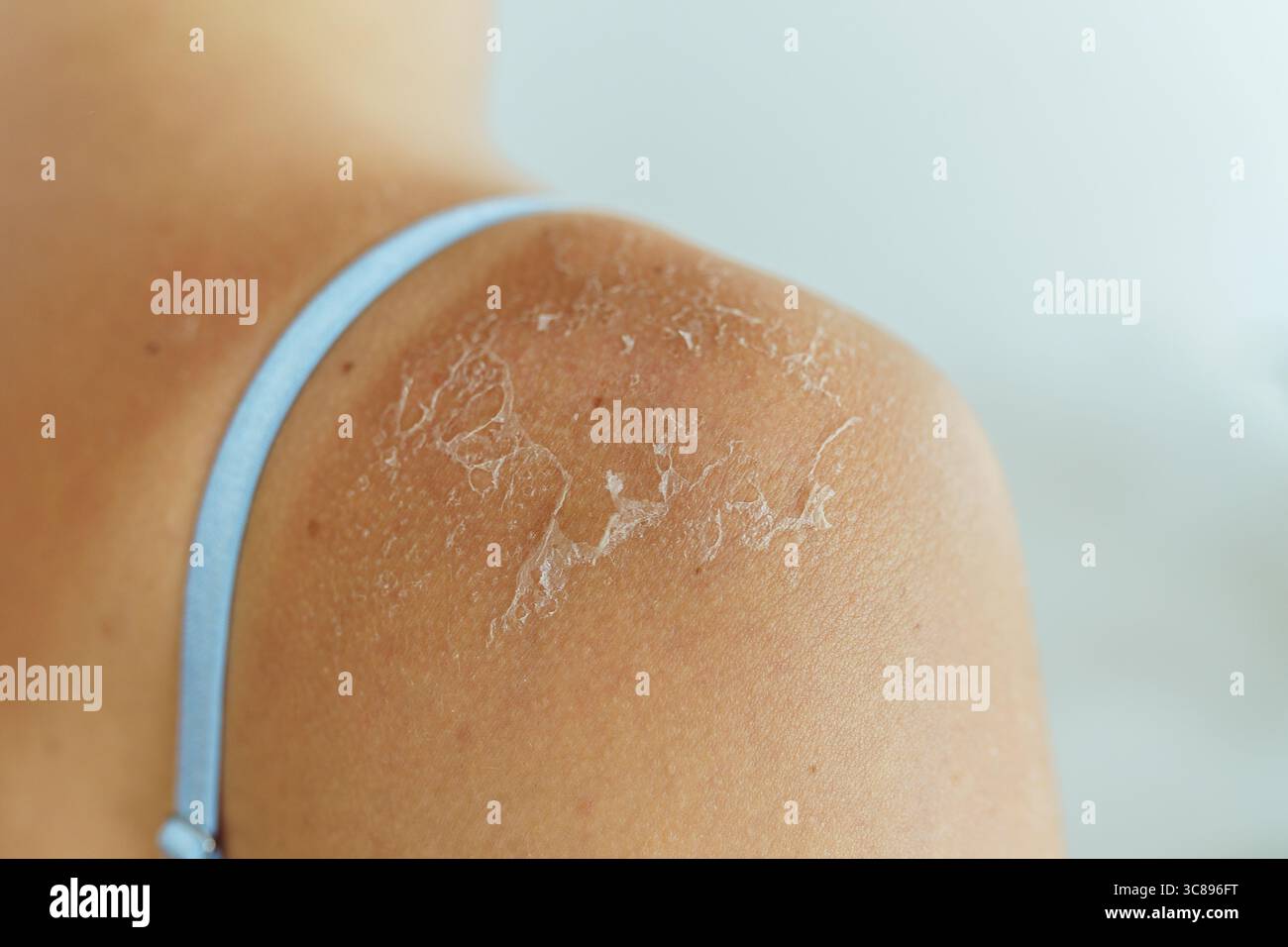 Peeling skin back shoulder hi-res stock photography and images - Alamy
