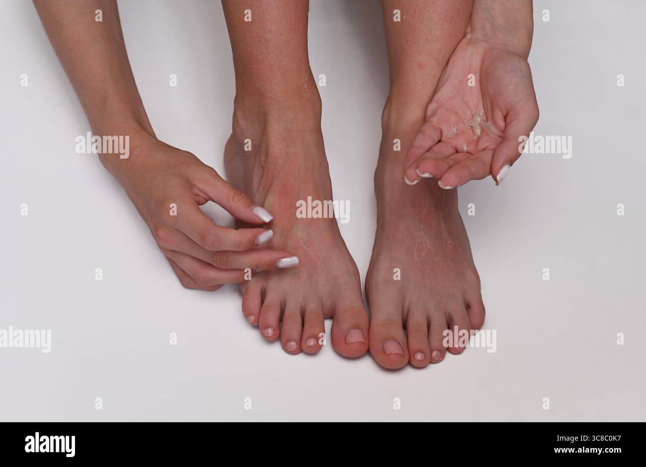 Skin peeling after sunbathing hi-res stock photography and images - Alamy