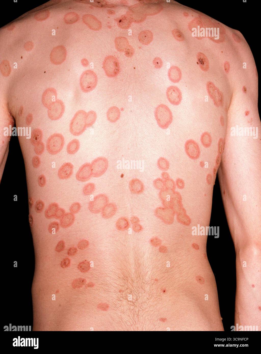 Linear immunoglobulin A (IgA) bullous dermatosis (LAD) affecting the ...