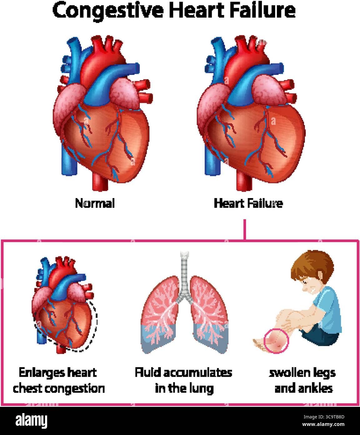 Detailed vector illustration showing normal and heart failure ...