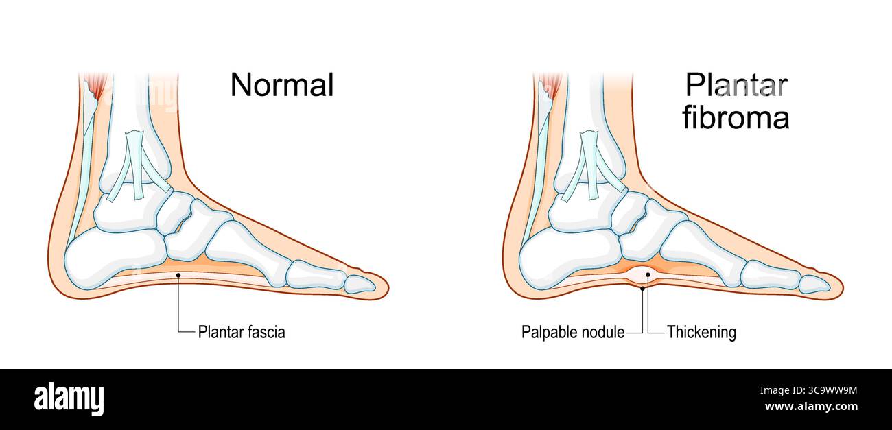Plantar fascial fibromatosis. Plantar fibroma. Ledderhoses disease ...