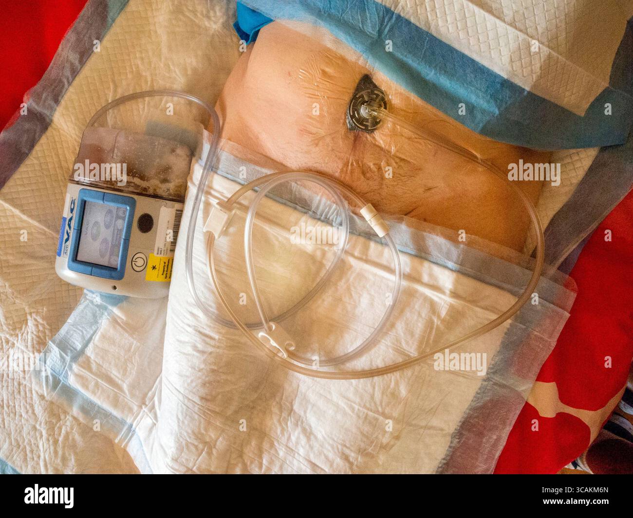 Wound vac hi-res stock photography and images - Alamy