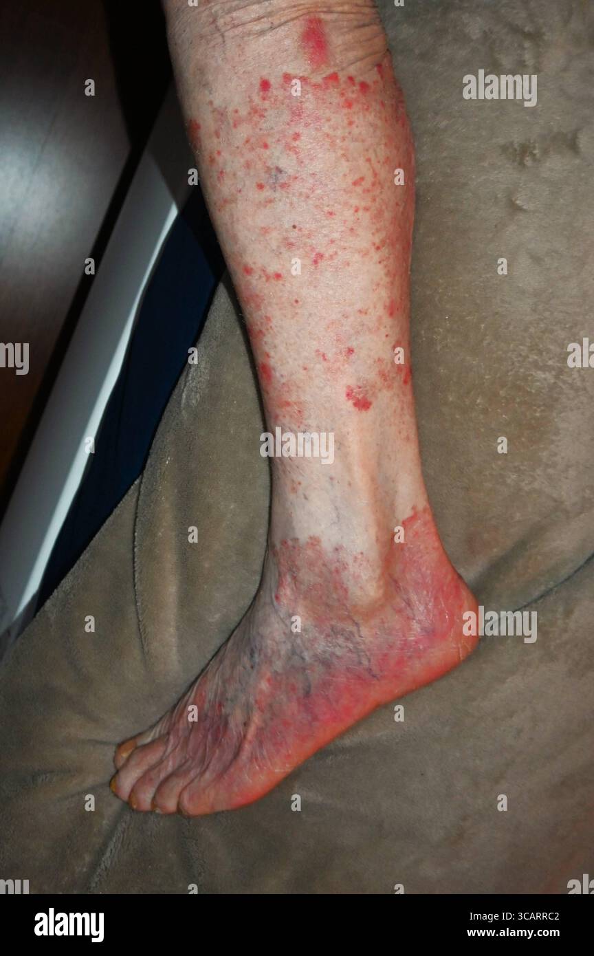 Untersuchung in der Dermatologie bzw beim Hautarzt nach einer ...