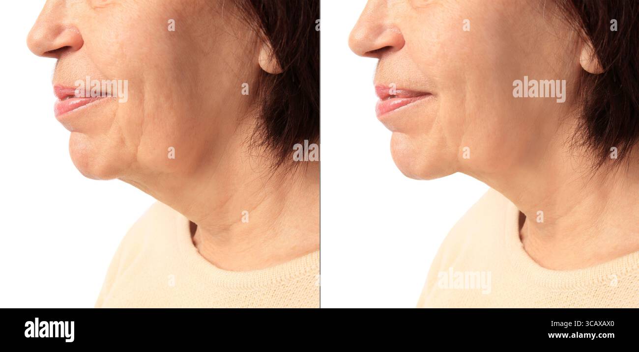 Ageing. Photos of woman's face, closeup of lower part. Collage showing ...
