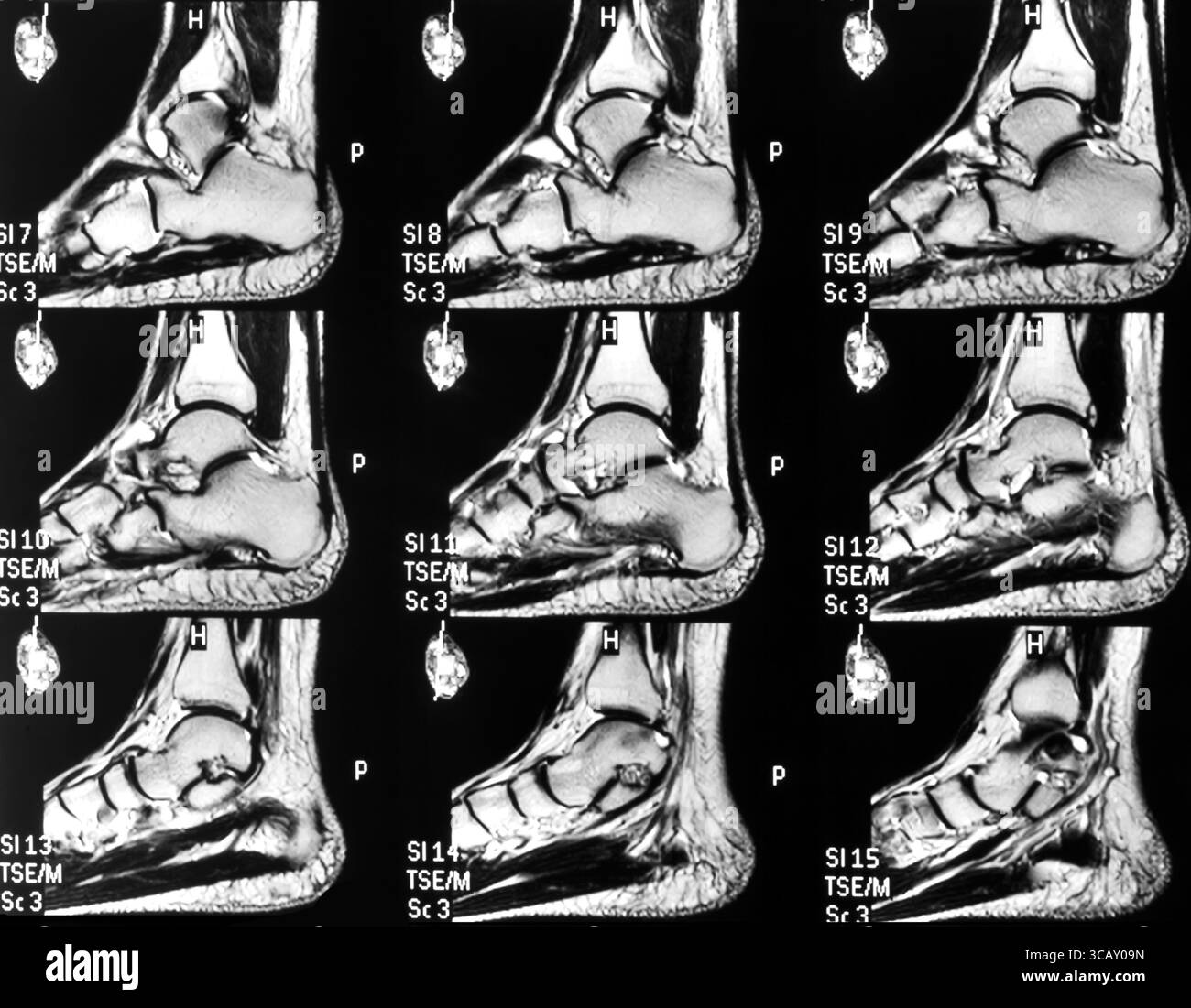 MRI Magnetic Resonance scan image of the left foot and ankle Stock ...