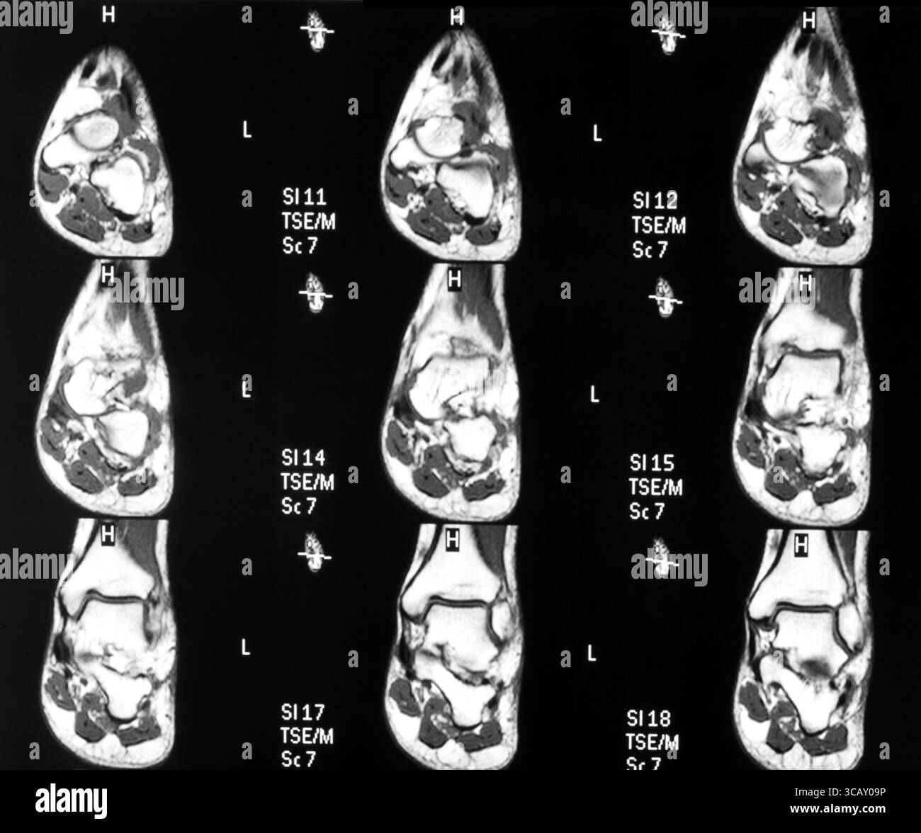 Ct scan leg Black and White Stock Photos & Images - Alamy
