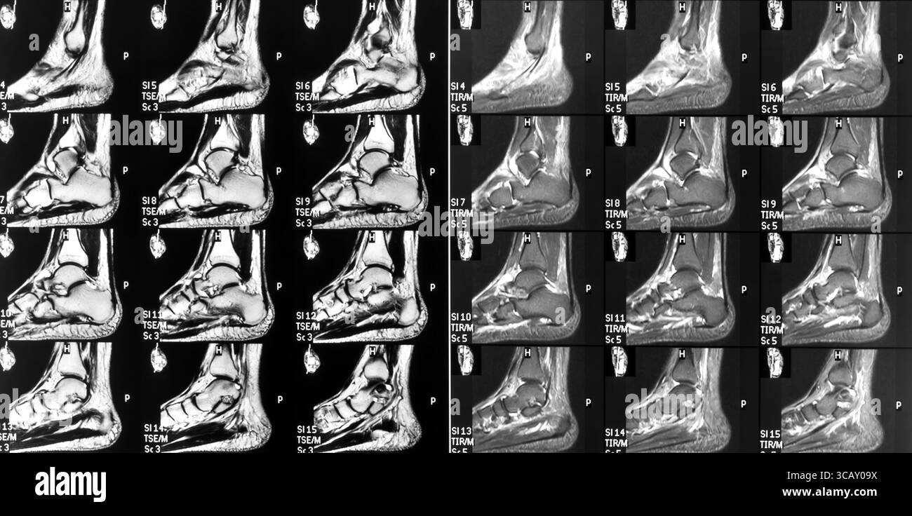 MRI Magnetic Resonance scan image of the left foot and ankle Stock ...