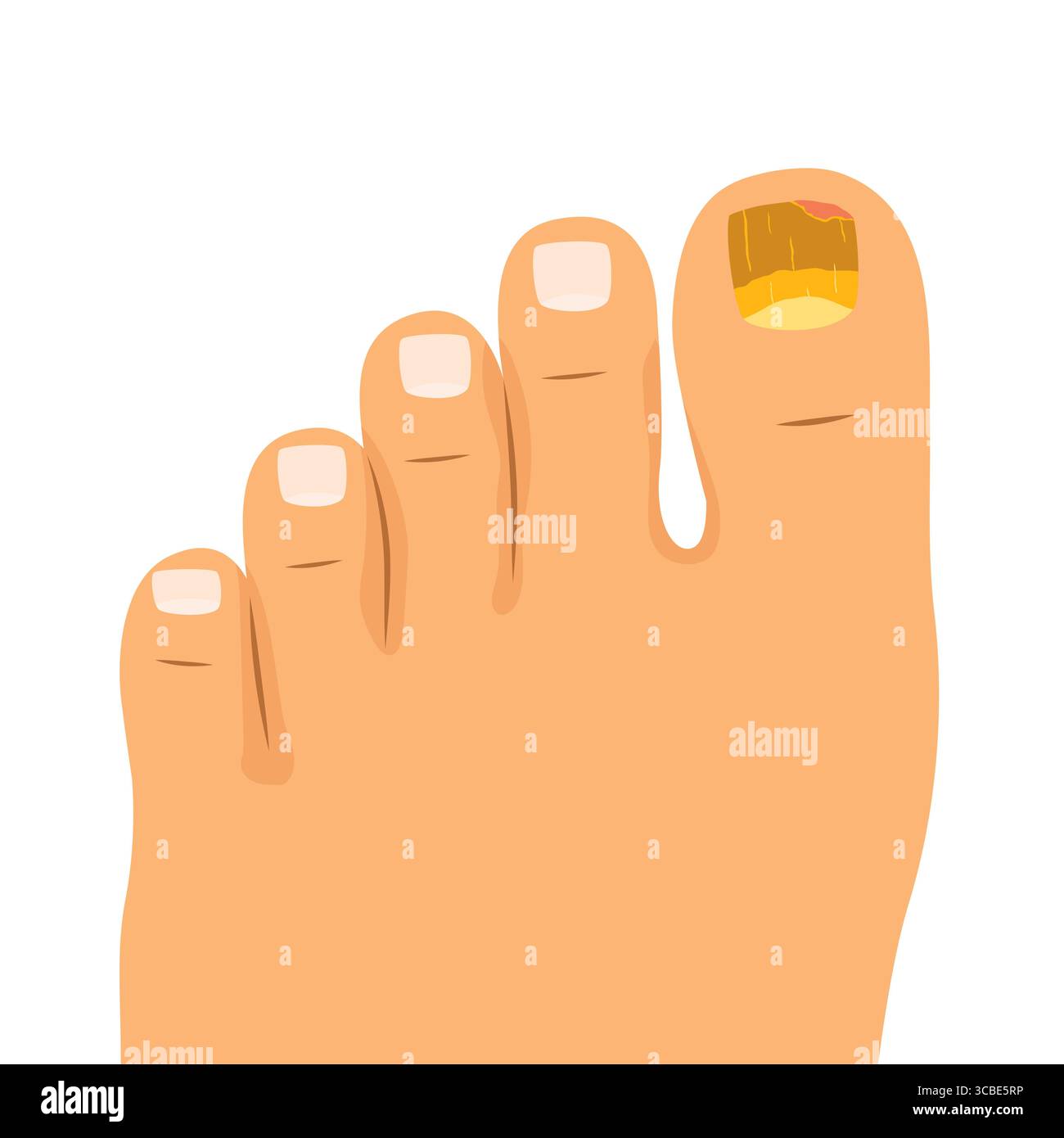 Fungal toenail infection Stock Vector Images - Alamy