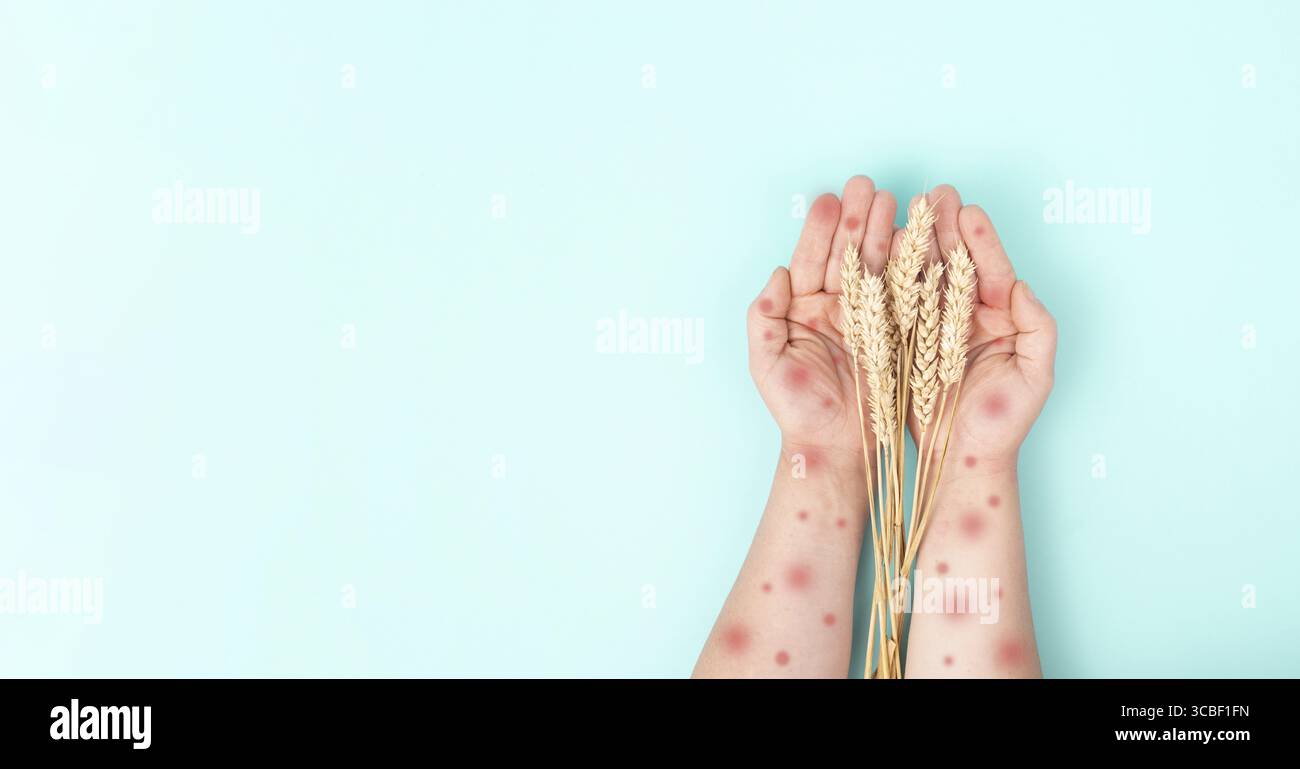 Gluten intolerance, celiac disease or wheat allergy, skin rash on the ...